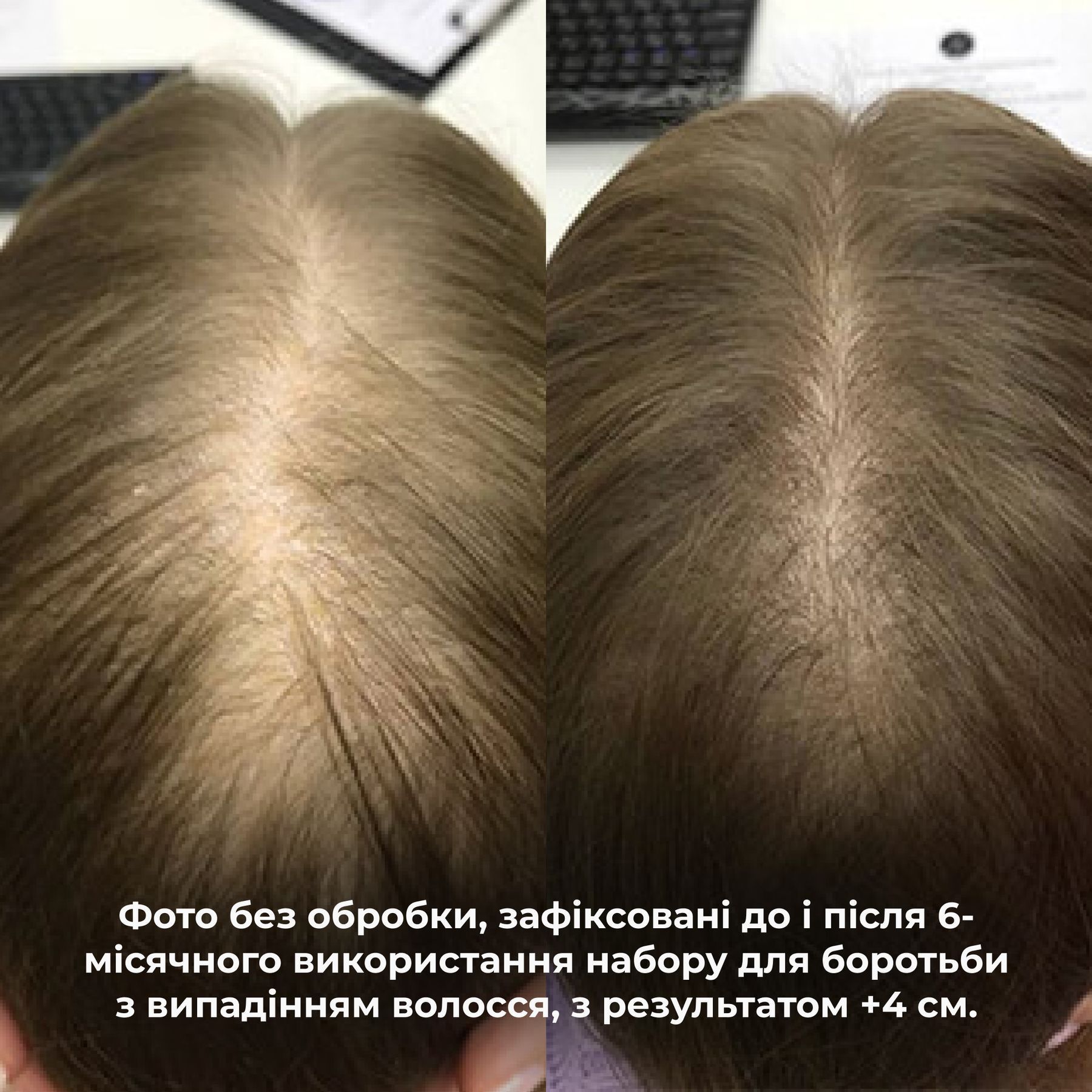 Шампунь проти випадіння волосся Hillary Serenoa & РР Hair Loss Control ...